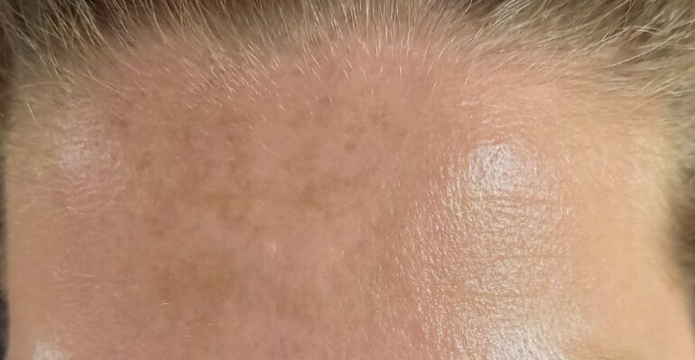 Melasma - Huid en Laserkliniek Dermalounge | Hilversum